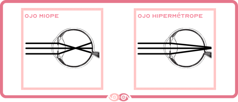 ¿Cuál Es La Diferencia Entre Hipermetropía Y Miopía? - Mi Mundo Visual