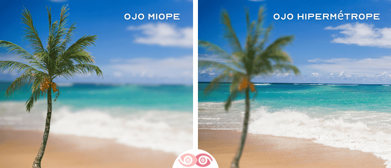 ¿Cuál Es La Diferencia Entre Hipermetropía Y Miopía? - Mi Mundo Visual