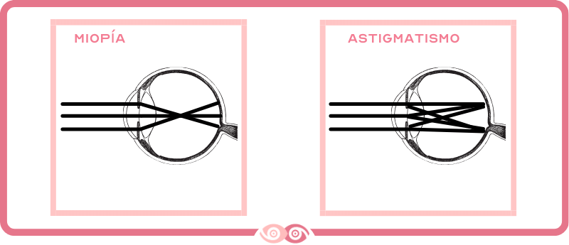 ¿Qué Diferencia Hay Entre La Miopía Y Astigmatismo? - Mi Mundo Visual